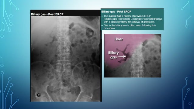 ABDOMINAL XRAYS REVIEW- EXTRALUMINAL GASES. | PDF