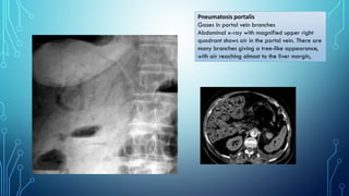 ABDOMINAL XRAYS REVIEW- EXTRALUMINAL GASES. | PDF