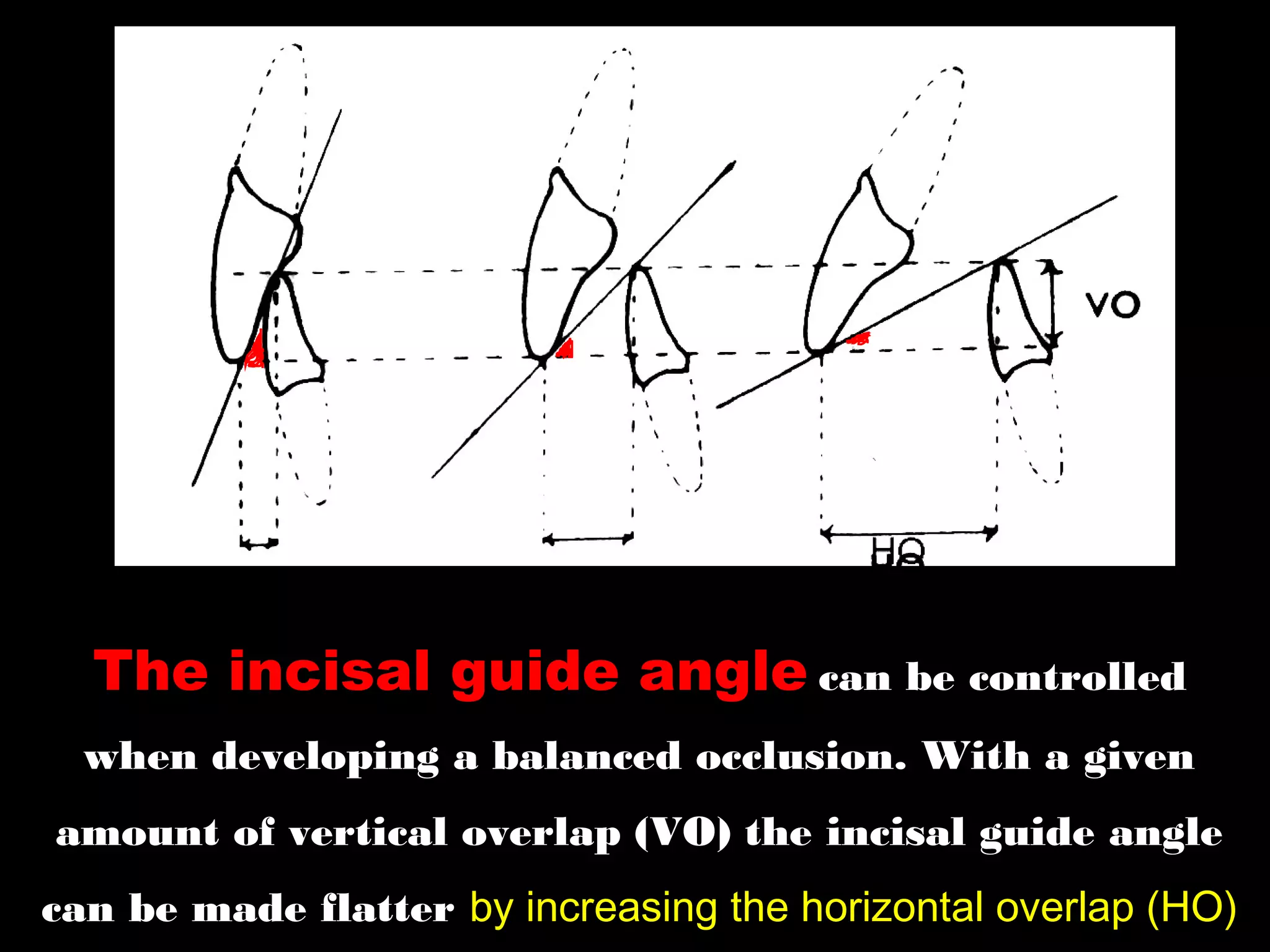 3- Factors affecting balanced occlusion final | PPT