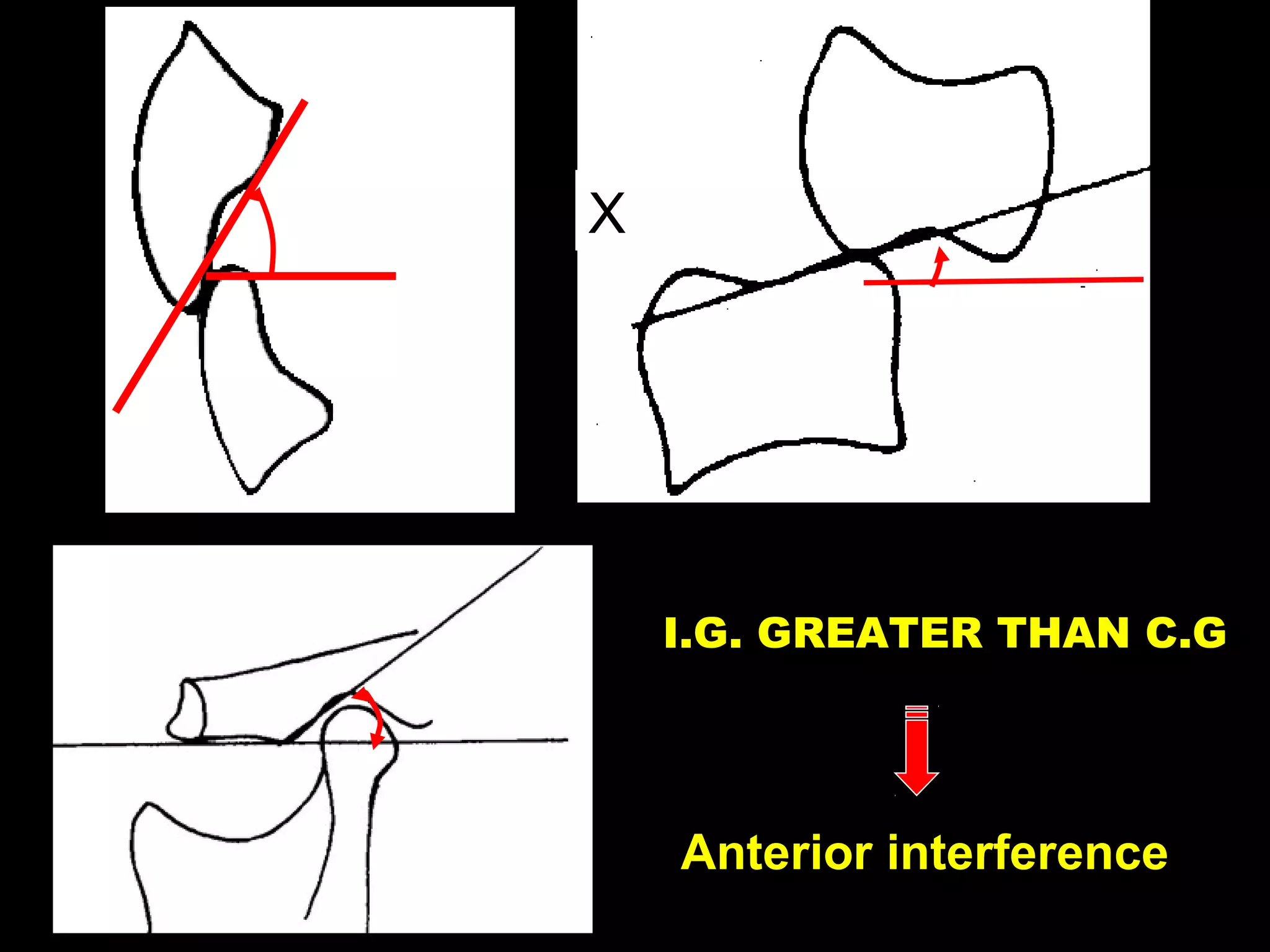 3- Factors affecting balanced occlusion final | PPT