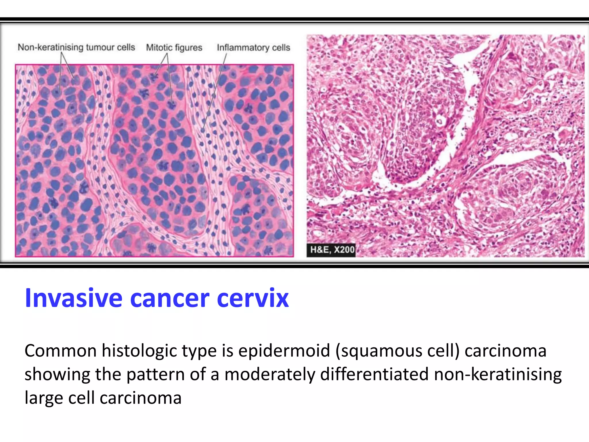 FEMALE GENITAL SYSTEM: INVASIVE CERVICAL CANCER | PPTX
