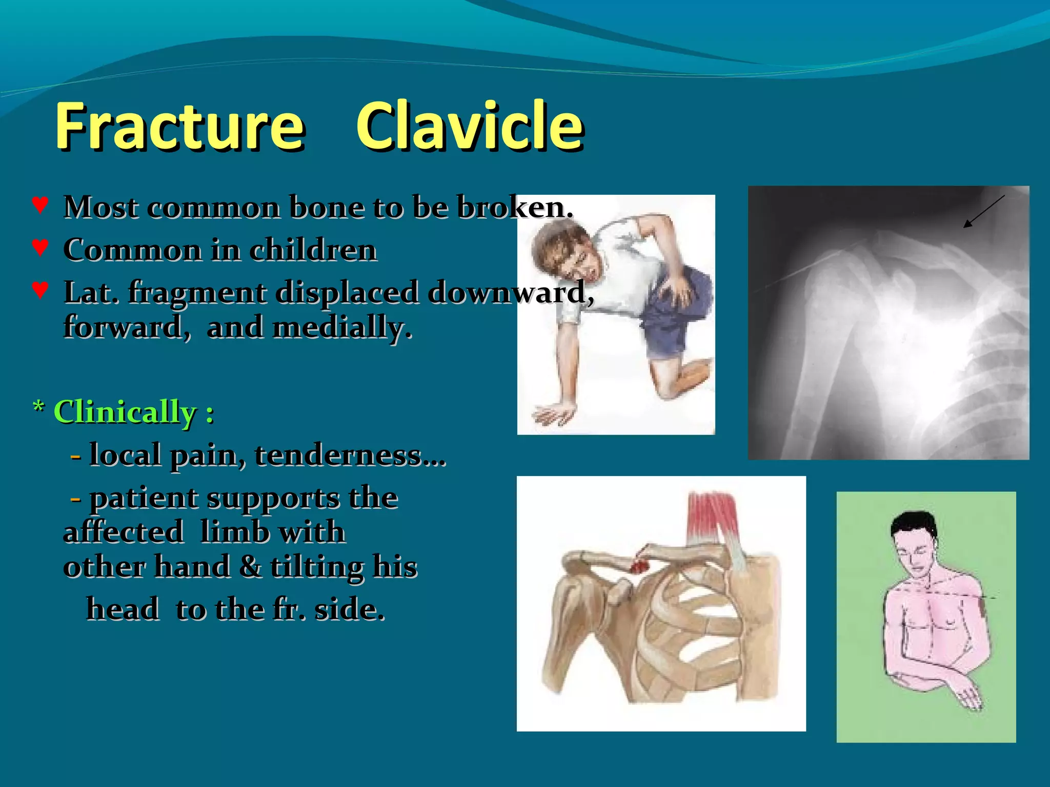 Fracture of Upper Limb | PPT