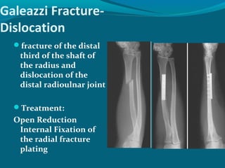 Fracture of Upper Limb | PPT