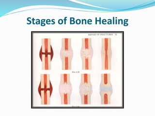 3 fracture healing | PPT