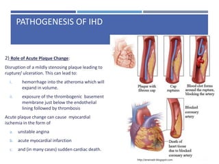 CVS pathology 3 - ischemic heart disease, angina and myocardial ...