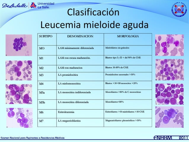 3. Leucemias agudas pediatría