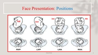 3 malpresentations.warda (3)- FACE PRESENTATION | PDF