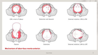 Face Presentation Mentum Posterior
