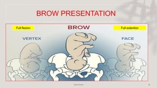 Face Presentation Mentum Posterior