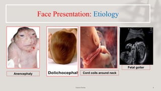 Face Presentation Birth