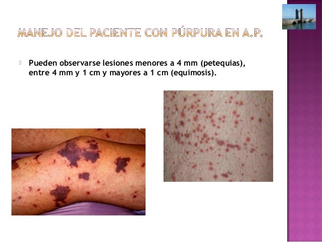 Equimosis Y Petequias Rubeola Y Sarampion