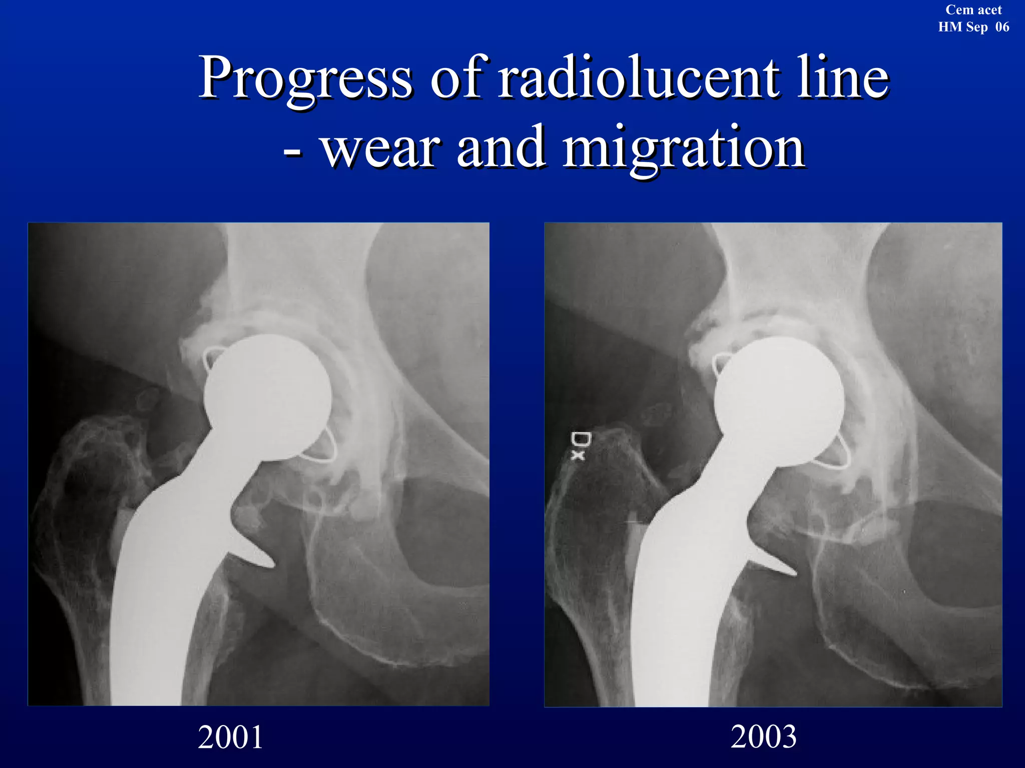Modern Cementing Technique: Acetabulum | PPT