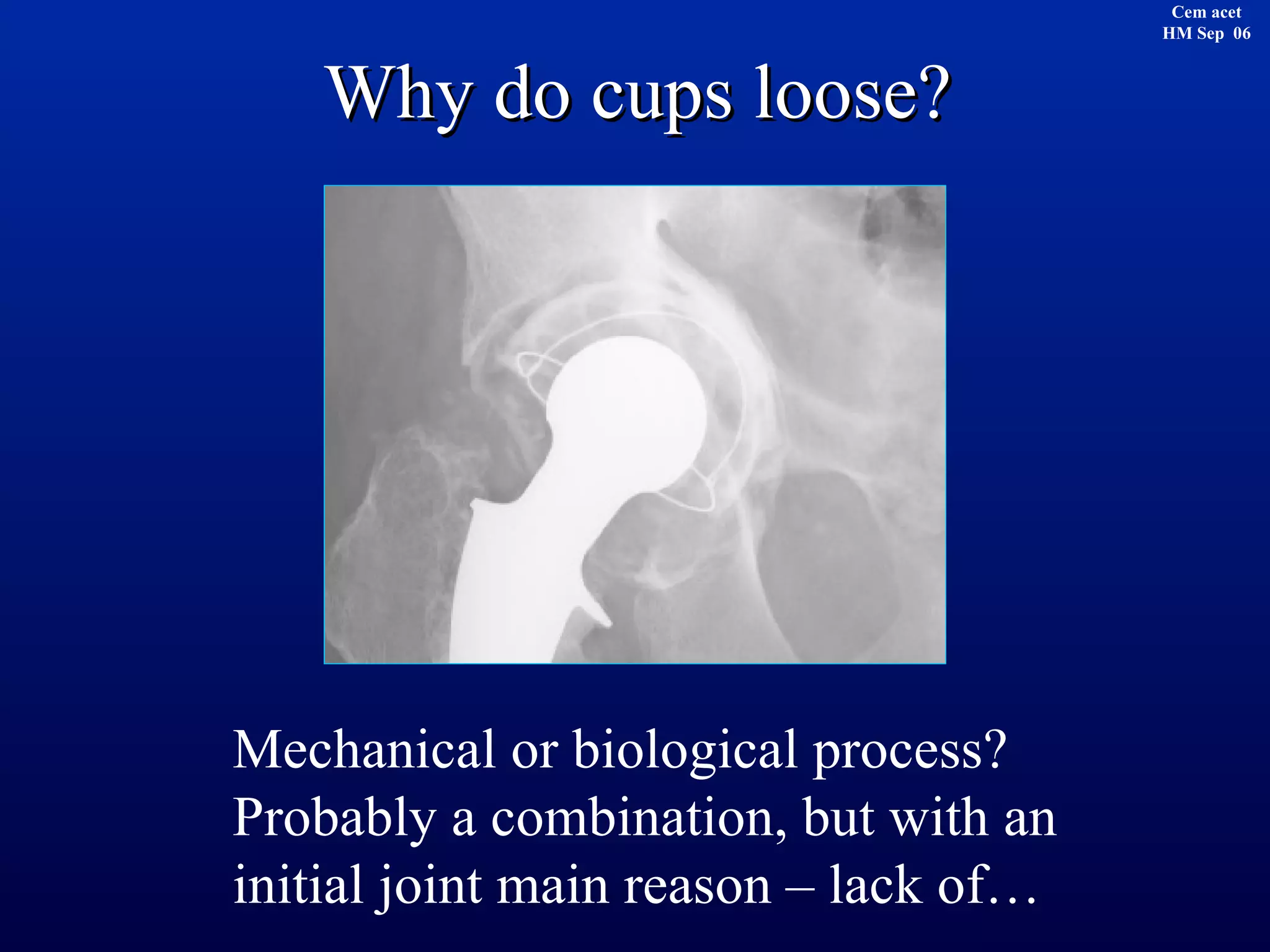 Modern Cementing Technique: Acetabulum | PPT