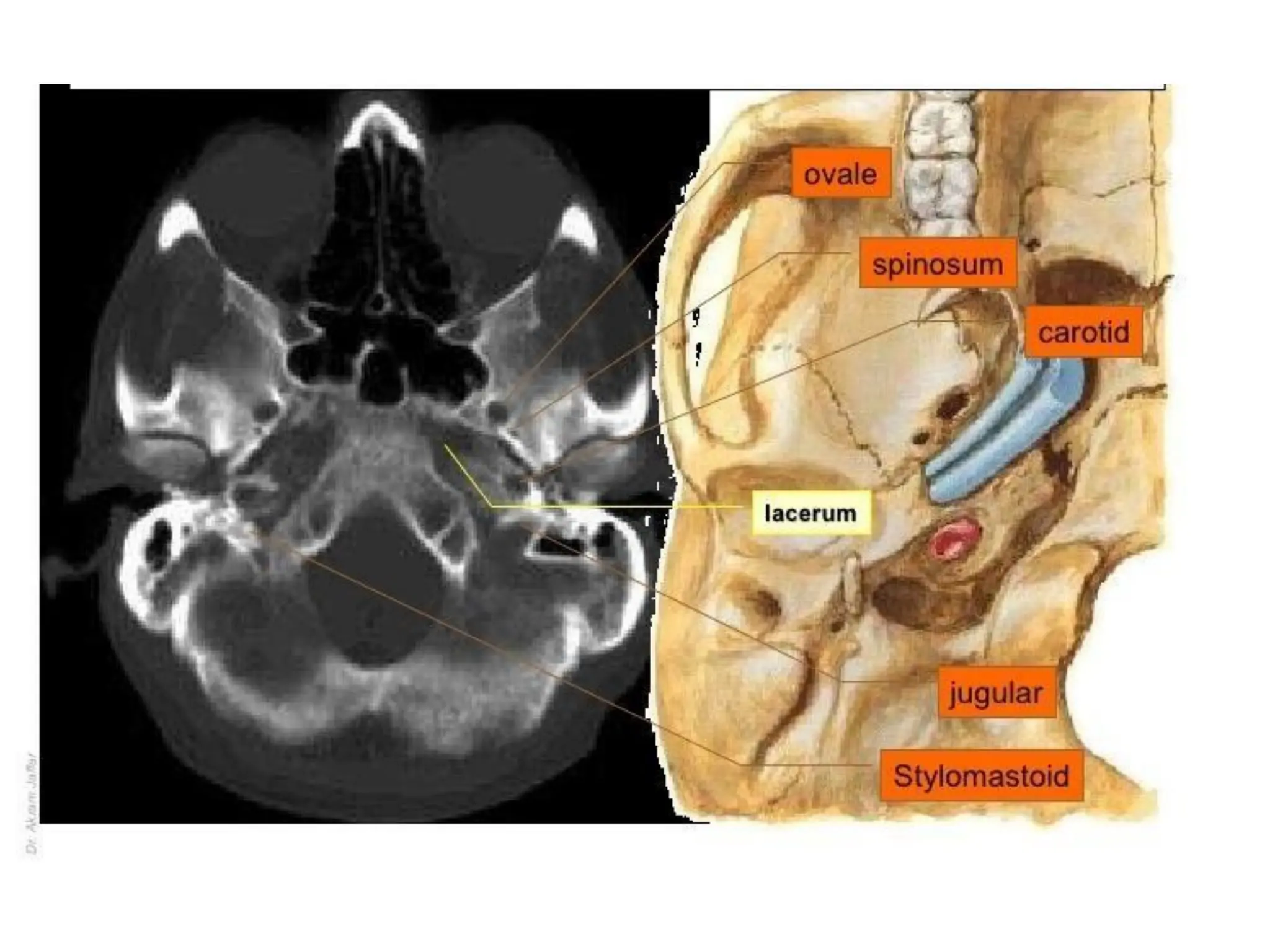 3-Norma Basalis ( Externa and Interna).pdf