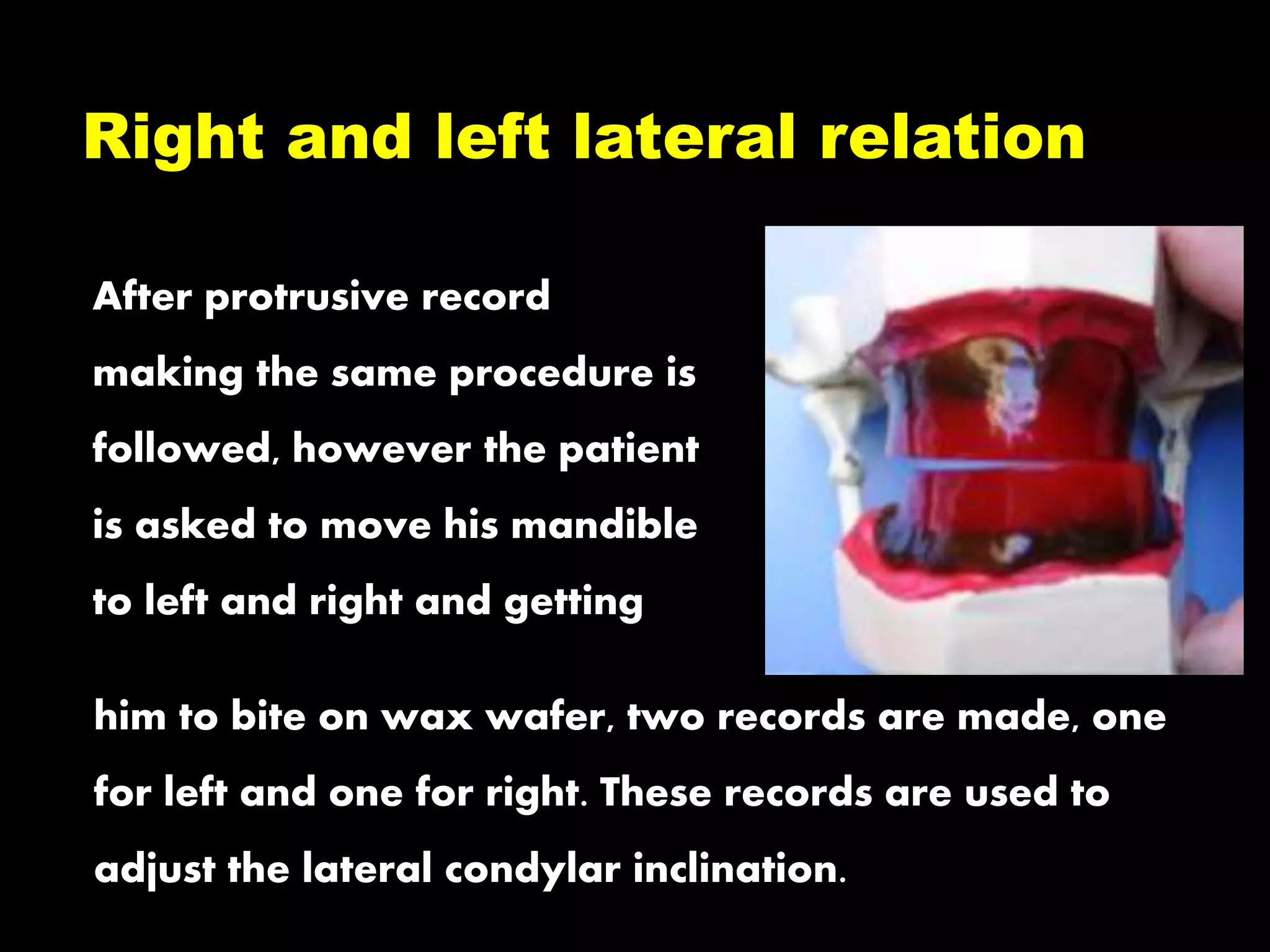 3- Occlusion in prosthodontics- Factors affecting balanced occlusion | PPTX