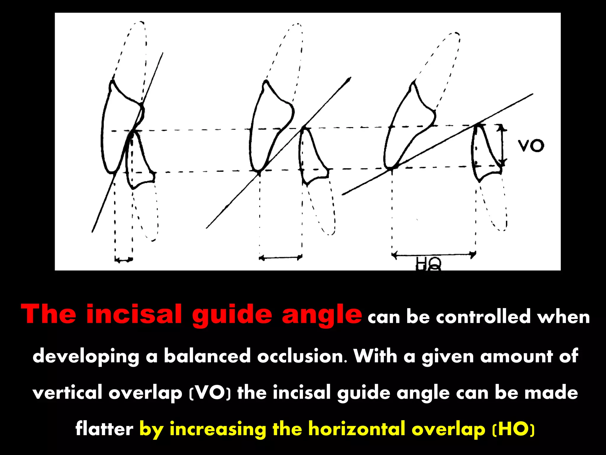 3- Occlusion in prosthodontics- Factors affecting balanced occlusion | PPTX