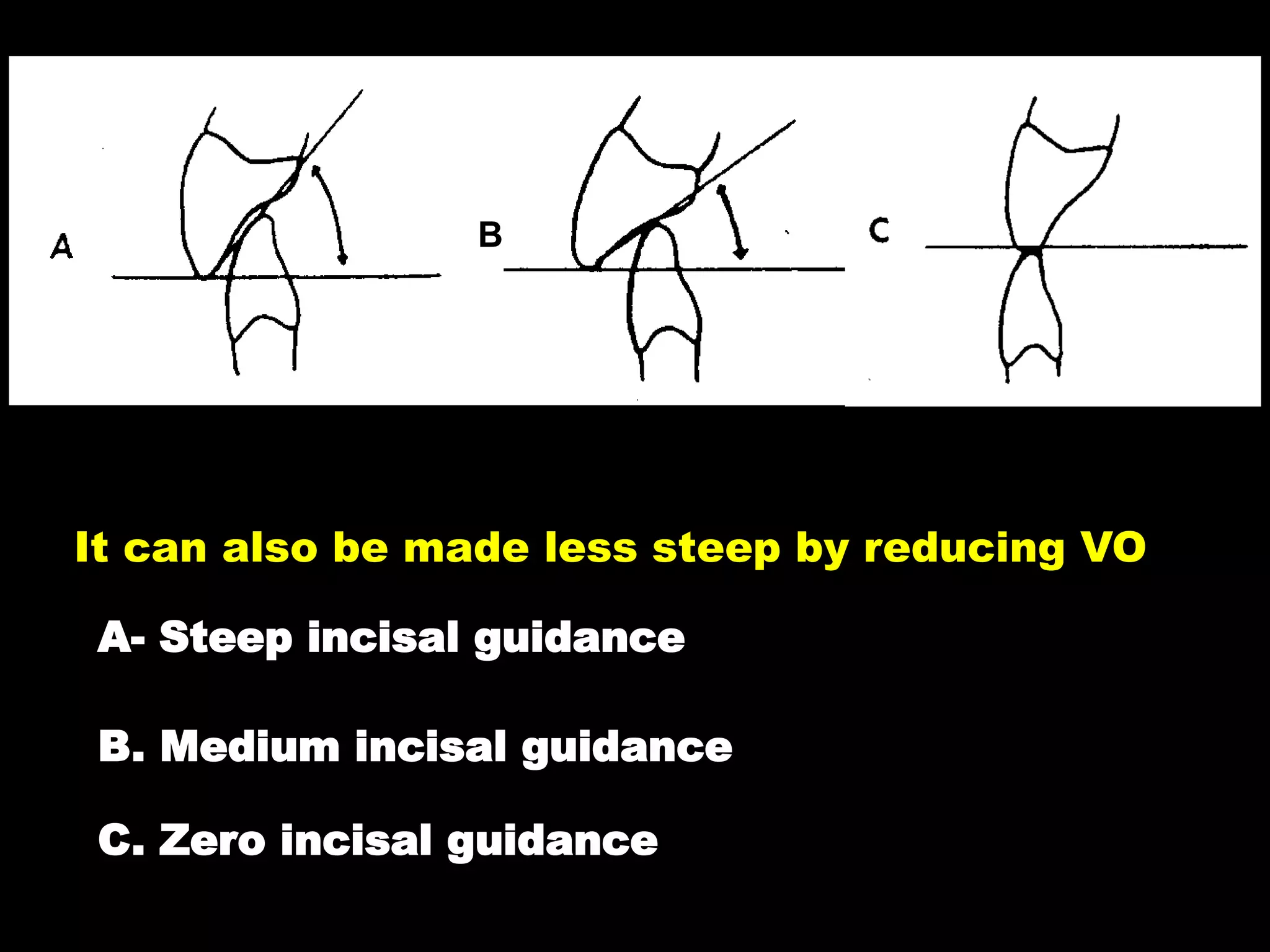 3- Occlusion in prosthodontics- Factors affecting balanced occlusion | PPTX