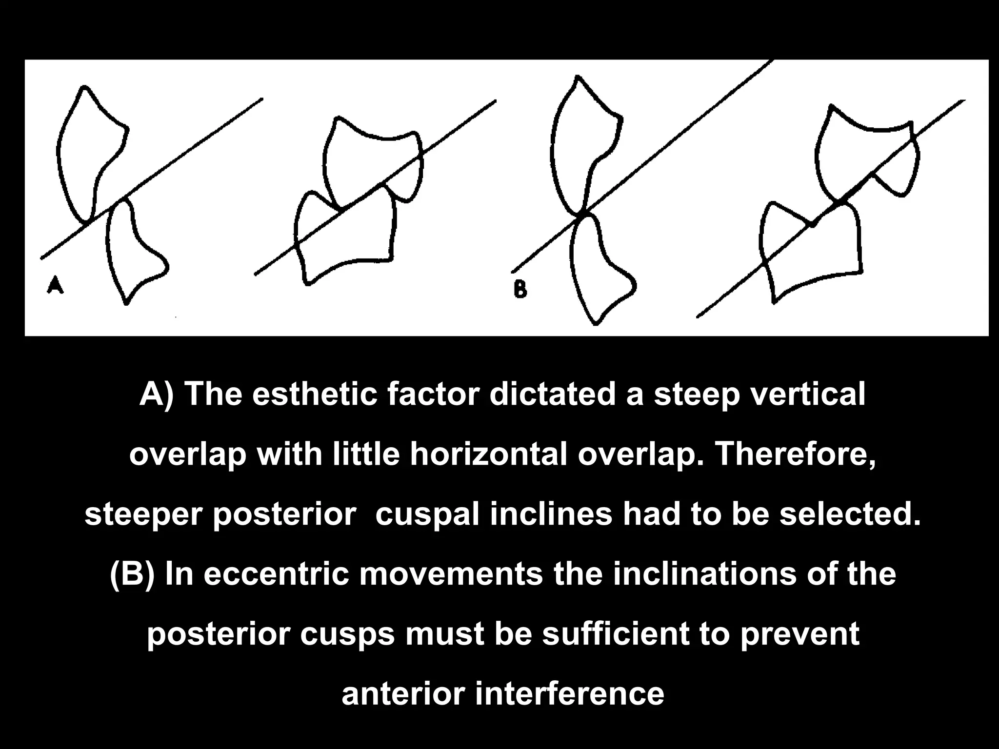 3- Occlusion in prosthodontics- Factors affecting balanced occlusion | PPTX