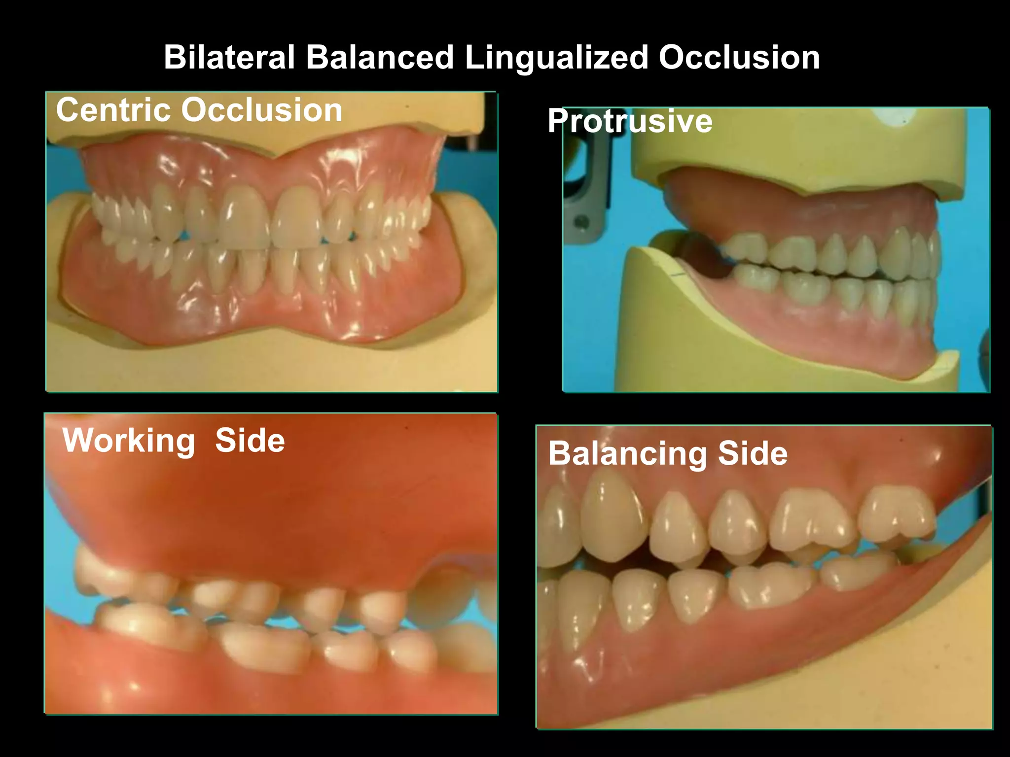 3- Occlusion in prosthodontics- Factors affecting balanced occlusion | PPTX