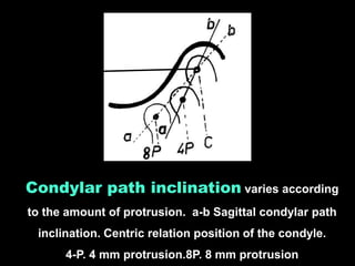 3- Occlusion in prosthodontics- Factors affecting balanced occlusion | PPTX
