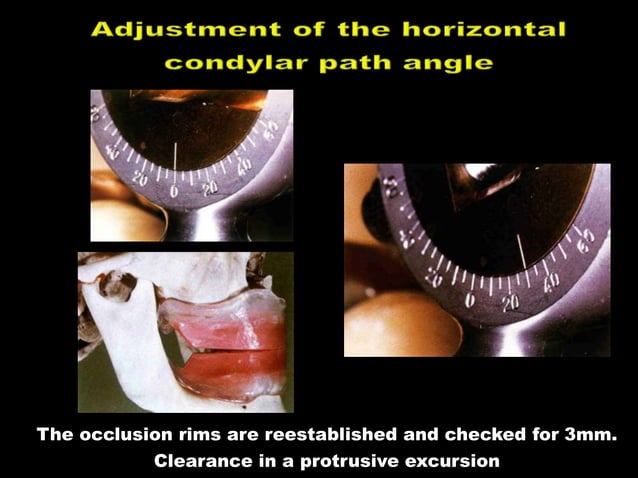 3- Occlusion in prosthodontics- Factors affecting balanced occlusion ...