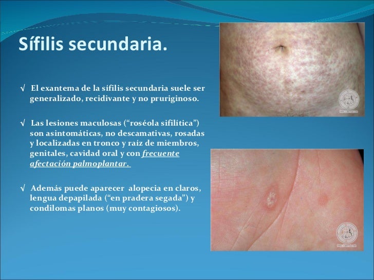 Paciente con úlcera genital