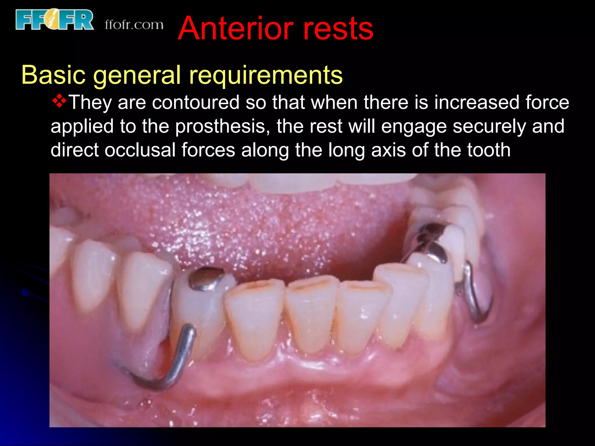 3.partial denture rests | PPT