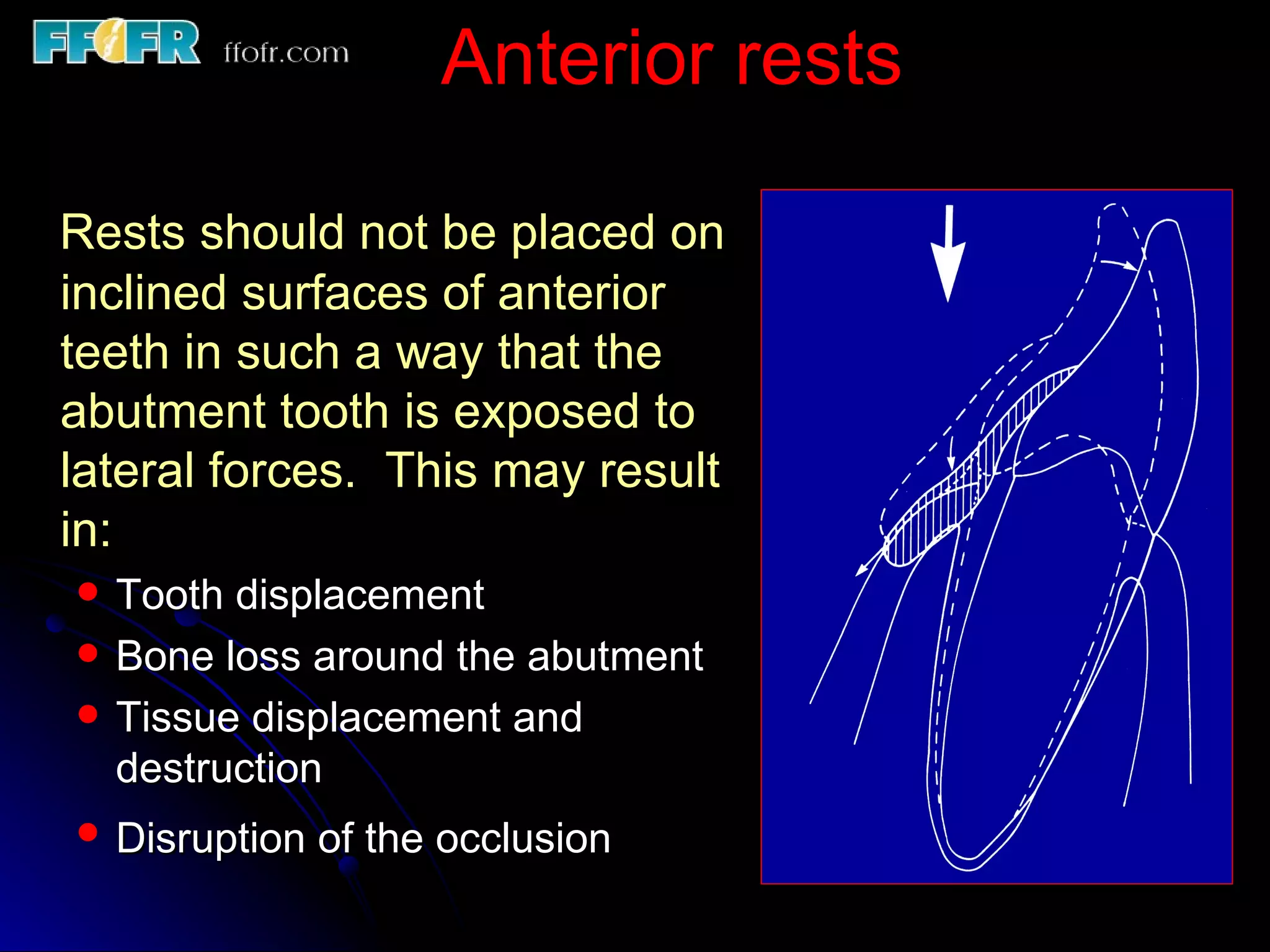 3.partial denture rests | PPT