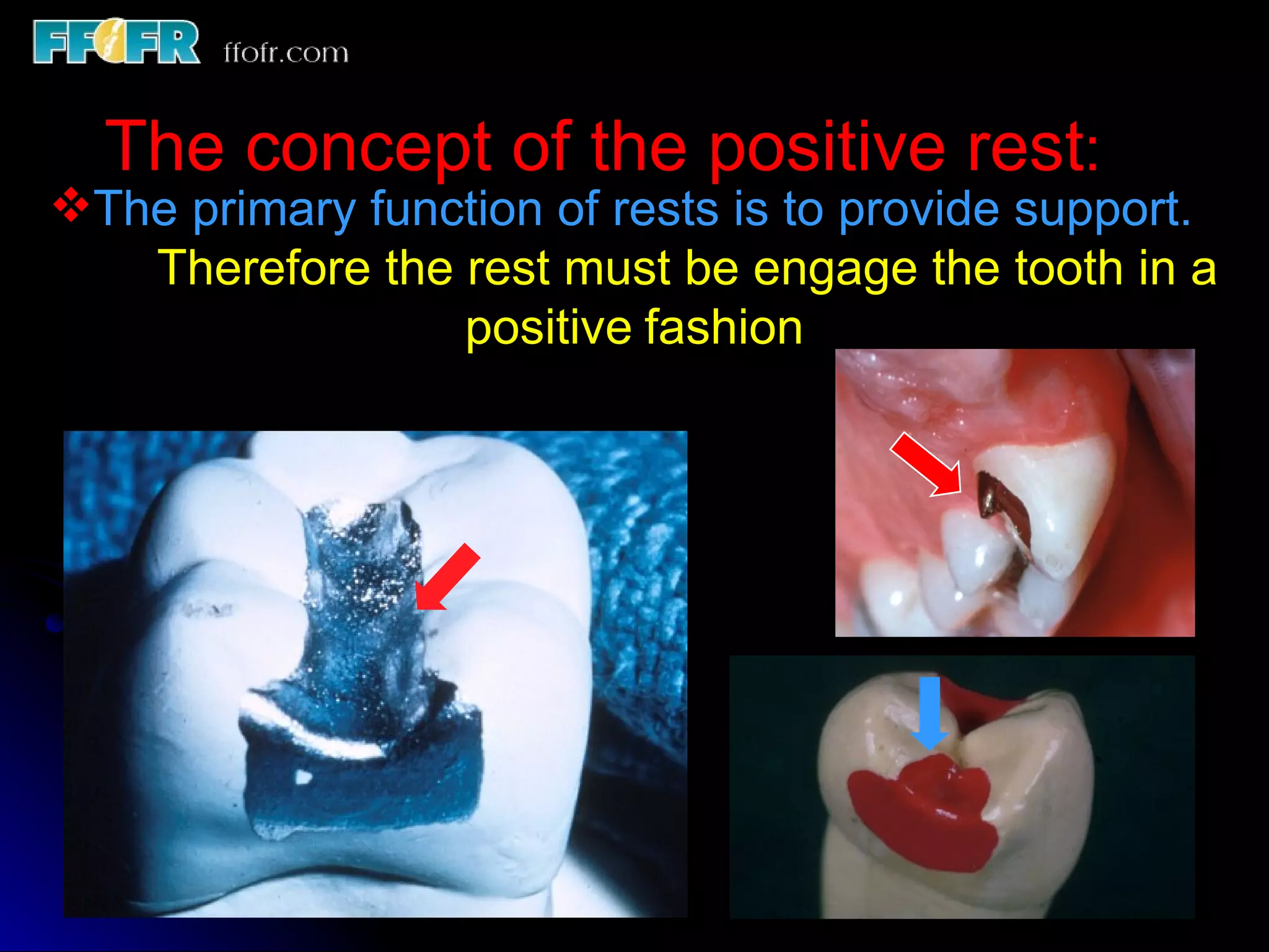 3.partial denture rests | PPT