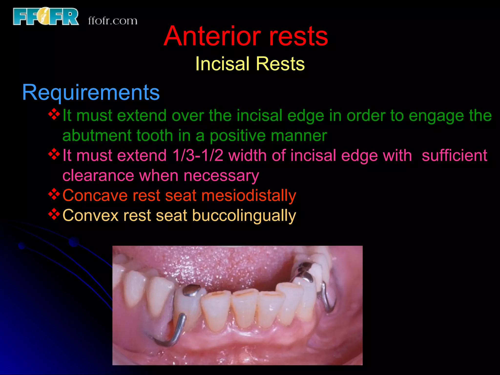 3.partial denture rests | PPT