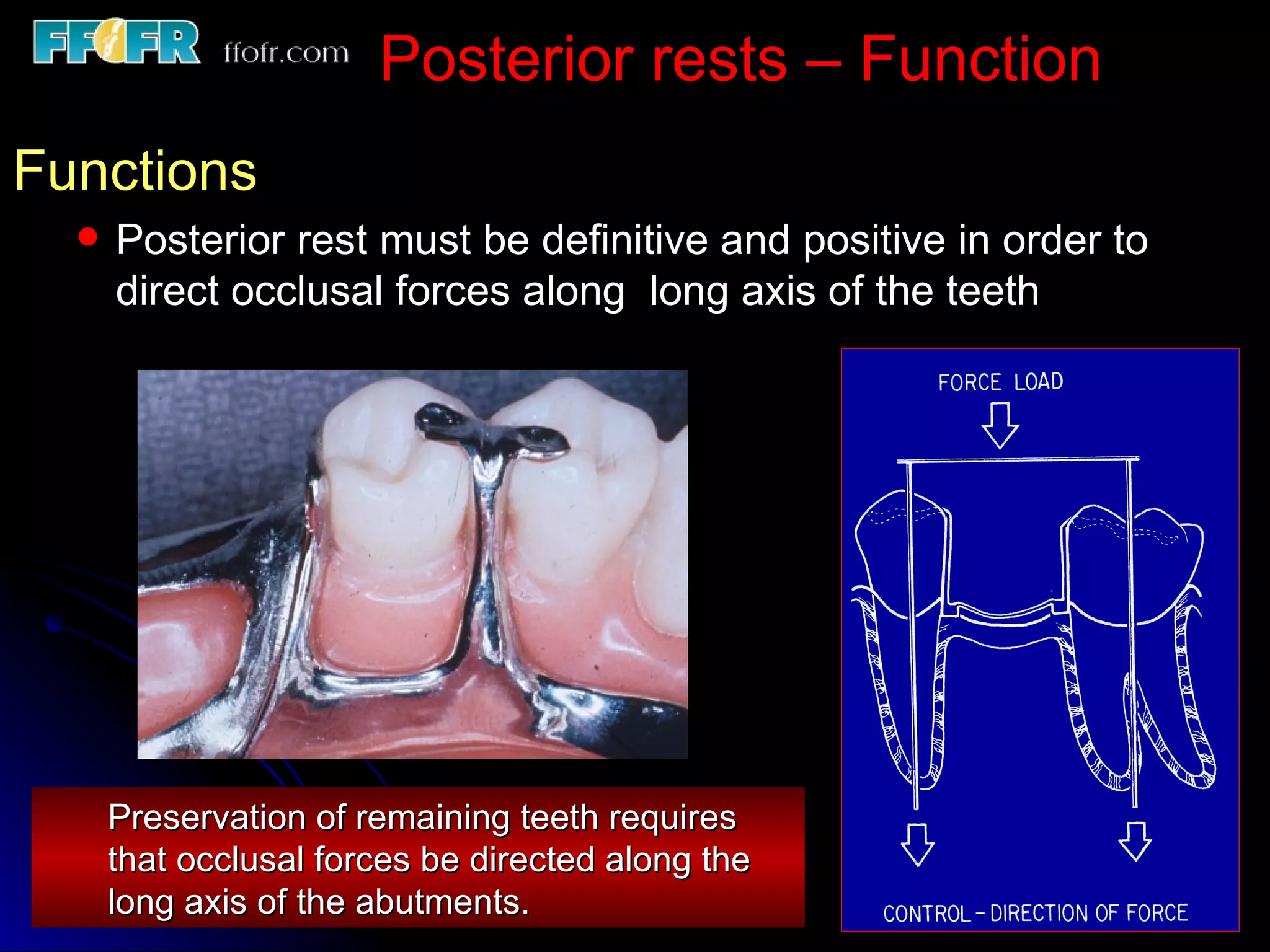3.partial denture rests | PPT