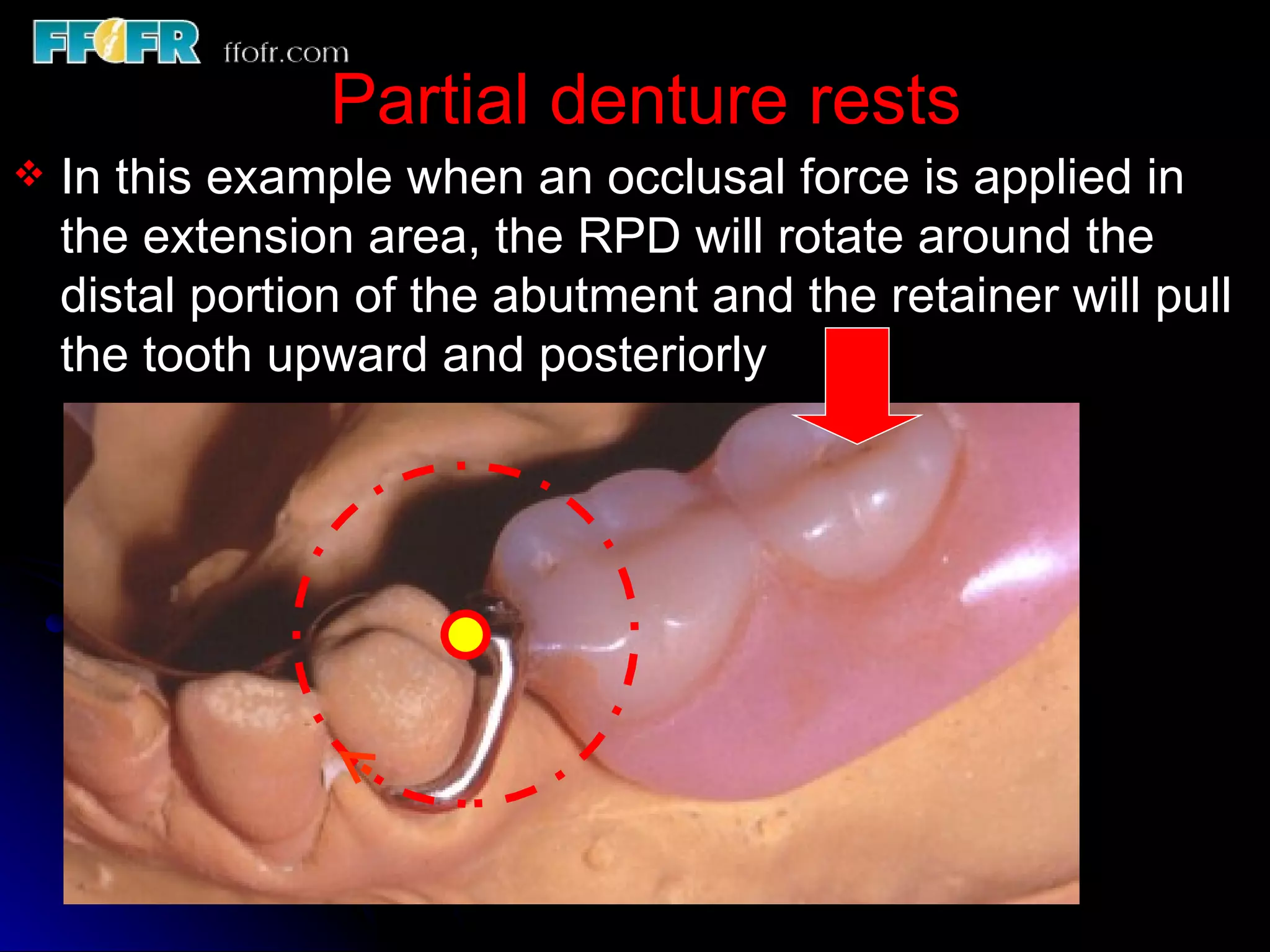 3.partial denture rests | PPT