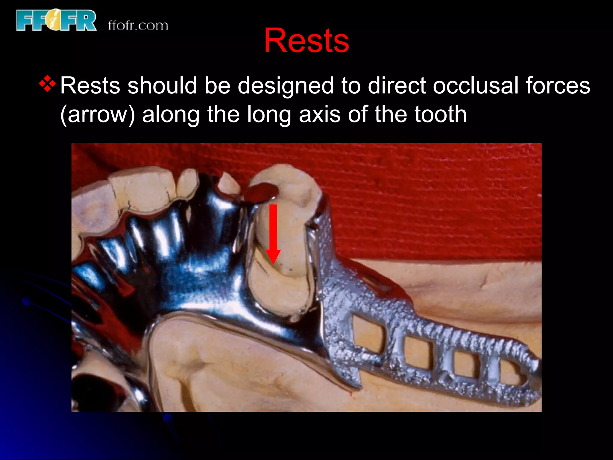 3.partial denture rests | PPT