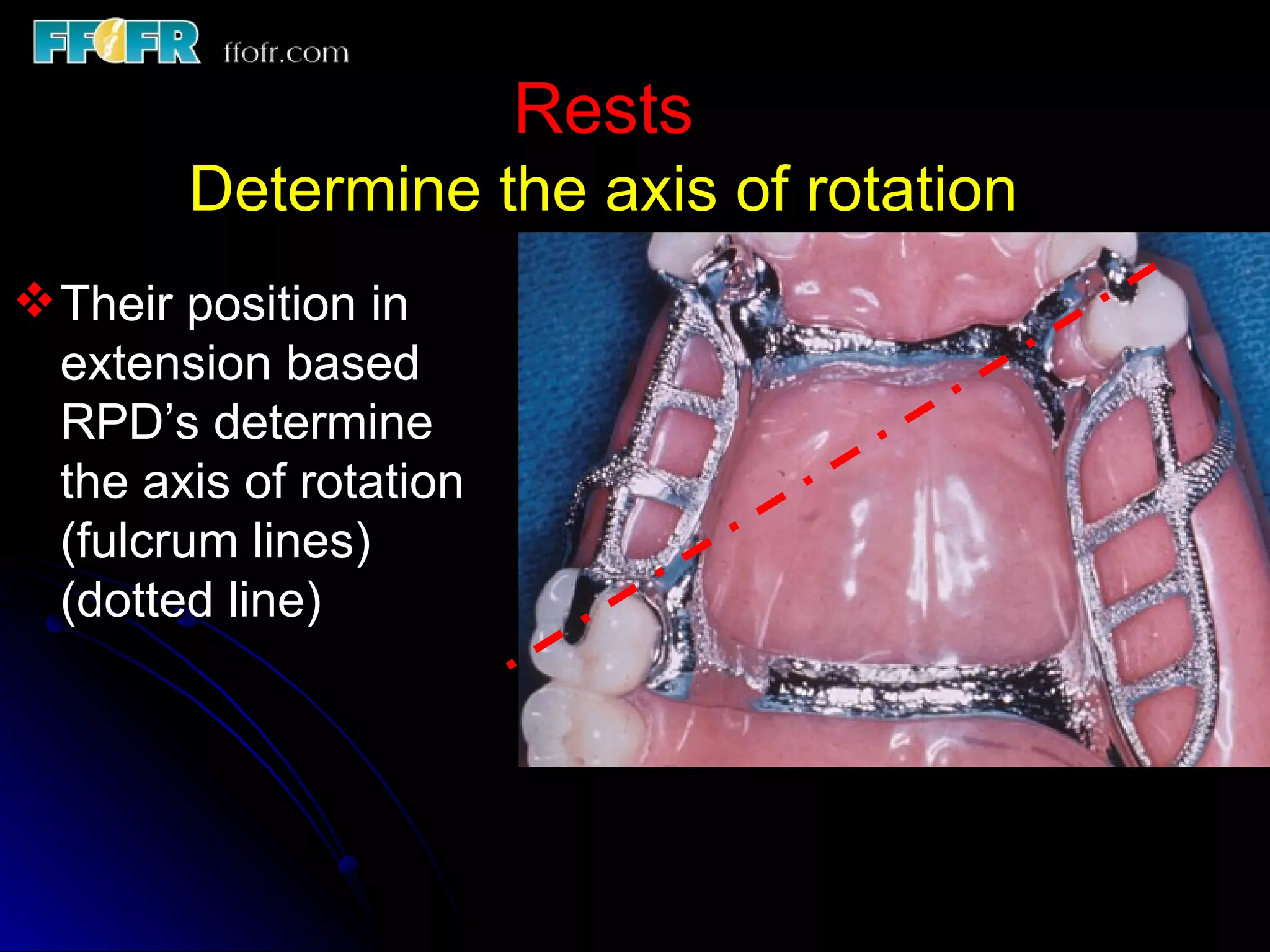 3.partial denture rests | PPT