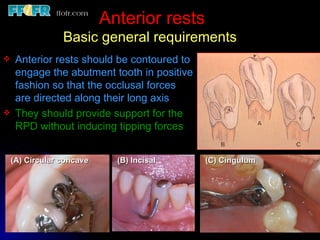3.partial denture rests | PPT