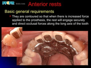 3.partial denture rests | PPT