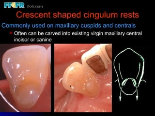 3.partial denture rests | PPT