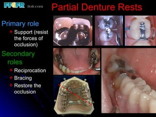 3.partial denture rests | PPT