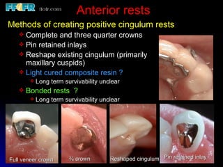3.partial denture rests | PPT