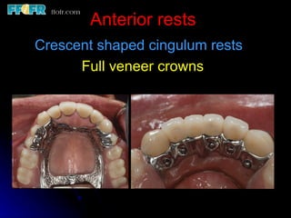 3.partial denture rests | PPT