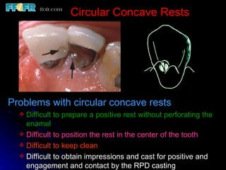 3.partial denture rests | PPT