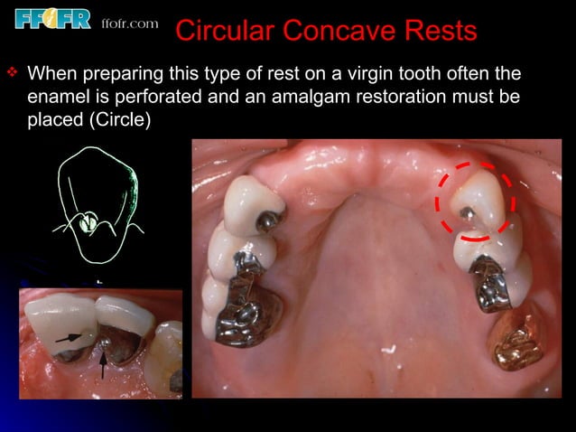 3.partial denture rests | PPT