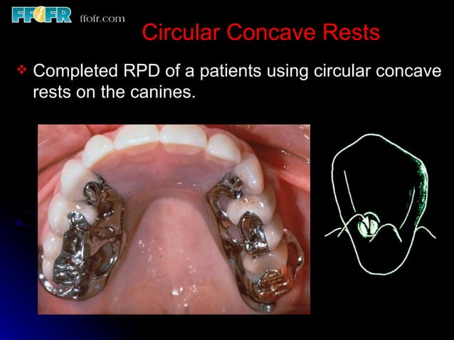 3.partial denture rests | PPT