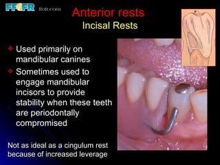 3.partial denture rests | PPT