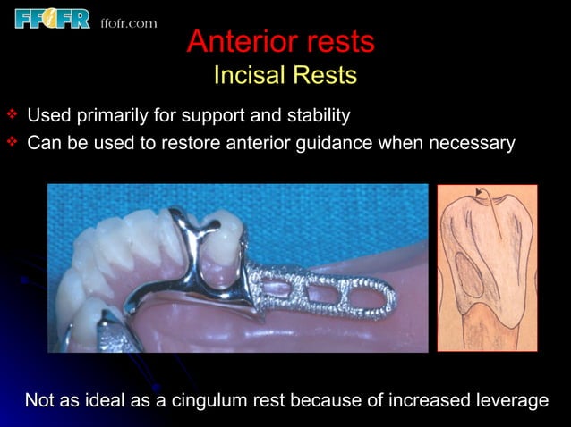 3.partial denture rests | PPT