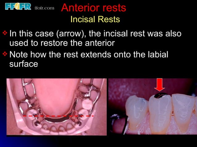 3.partial denture rests | PPT