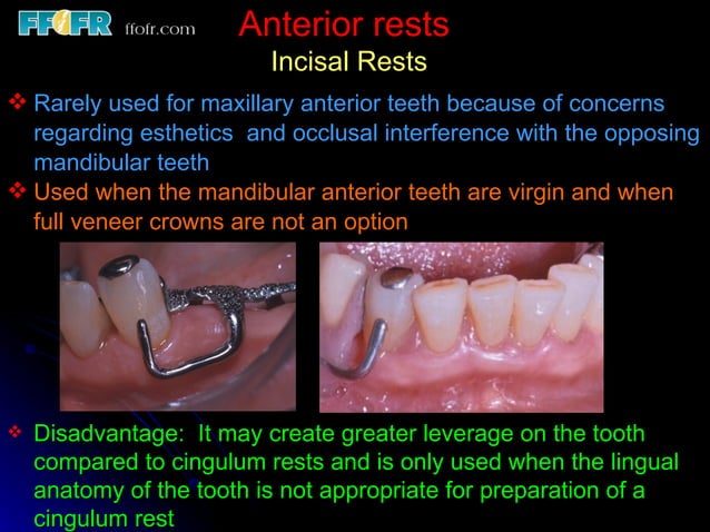 3.partial denture rests | PPT