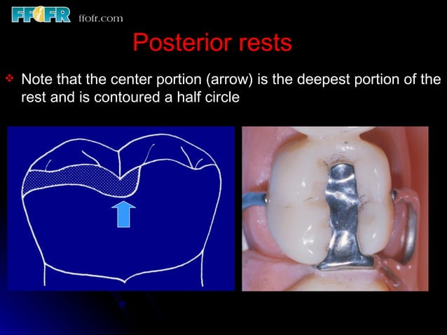 3.partial denture rests | PPT