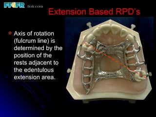 3.partial denture rests | PPT