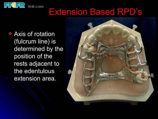 3.partial denture rests | PPT